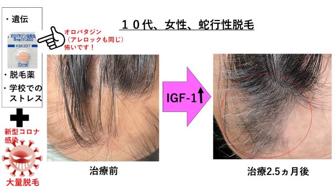 新型コロナ感染当日に大量脱毛して発症した蛇行性脱毛患者さんで改善！ 患者様からの声・メディア掲載・クリニックからのお知らせ 名古屋kクリニック